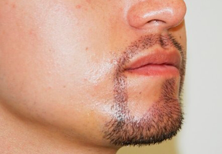BEARD, MUSTACHE AND EYEBROW MICRO-GRAFTING | Kbapel Microinjerto ...