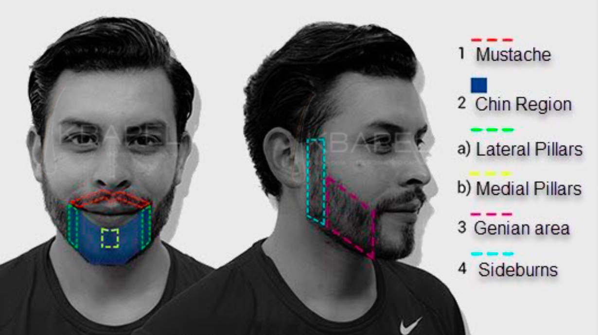Trasplante capilar de Barba y Bigote | Clínica Kbapel